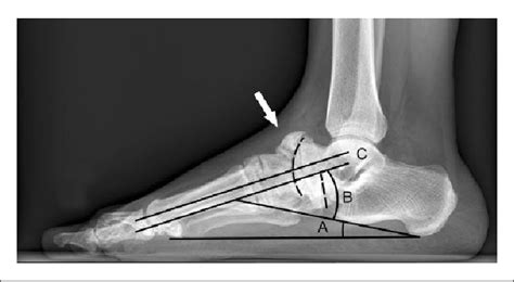 Lateral Plain Radiograph With A The Calcaneal Pitch B The Lateral