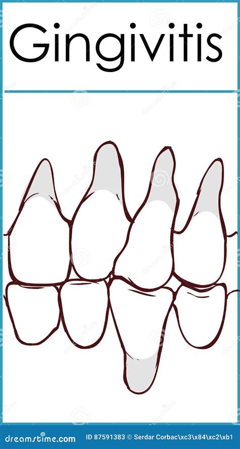 Gingivitis Inflammation Of The Gums Stock Vector Illustration Of