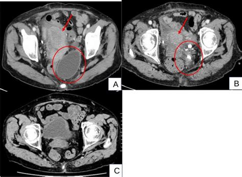 Pelvic Inflammatory Pseudotumor With Calcium Polystyrene Sulfonate