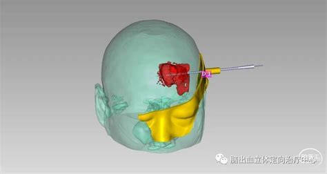 3d打印手术导板减少开颅手术几率 脑医汇