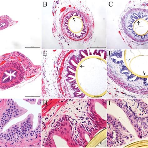 Schematic Diagram Of The Ureteral Anastomosis Procedure With Polyimide