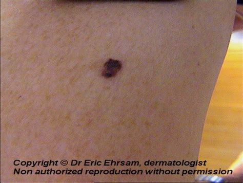 Dermoscopy Regression Structures