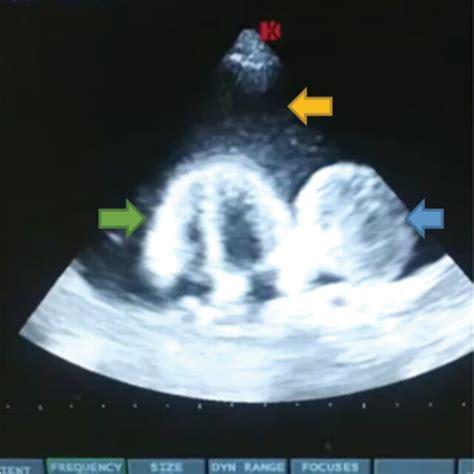 An Echocardiogram Revealed A Massive Pericardial Effusion With Large