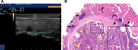 A 49 Year Old Woman With Ht And Ptmc In The Right Lobe Of The Thyroid Download Scientific