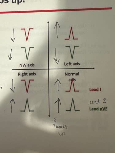 Ekg Leads And Axis Flashcards Quizlet
