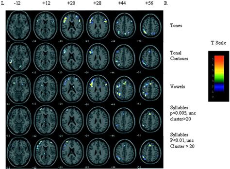 Activation From The Spm Z Maps In The Axial View The Contrasts Download Scientific Diagram
