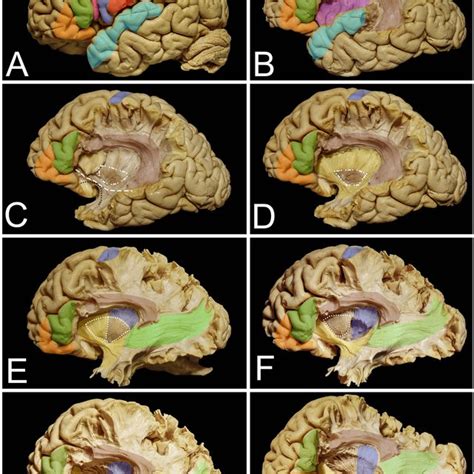 Exposure Of The Insular Cortex And Subcortical Region Was Achieved With