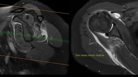 Teres Minor And Infraspinatus Tear Mri Youtube