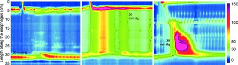 High Resolution Manometry Of Achalasia Subtypes Type I Achalasia Is