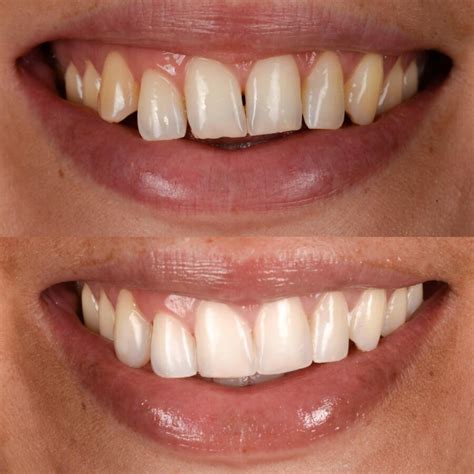 Få Perfekte Tenner Med Edge Bonding Non Invasive