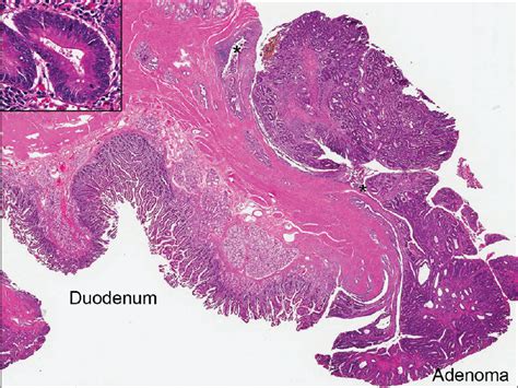 Ampulla Of Vater Histology
