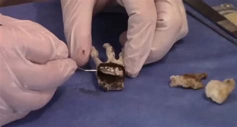 Researchers Uncover Mysterious Implant In Perus Three Fingered Mummy