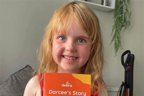 Darcee 5 Is Cover Star Of Book Explaining Her Skin Condition To