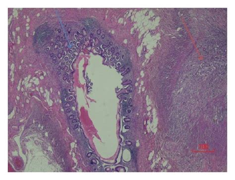 A Core Needle Biopsy Of The Left Breast Shows An Invasive Moderately