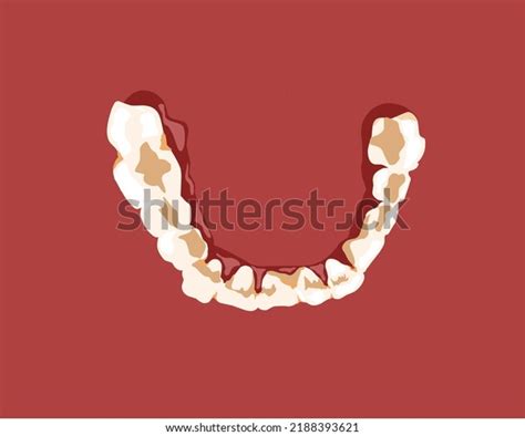 Gingivitis Inflammation Gums Dental Calculus Infographics Stock Vector