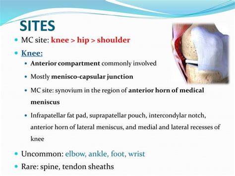 Pigmented Villonodular Synovitis Pptx Death Injury Or Military
