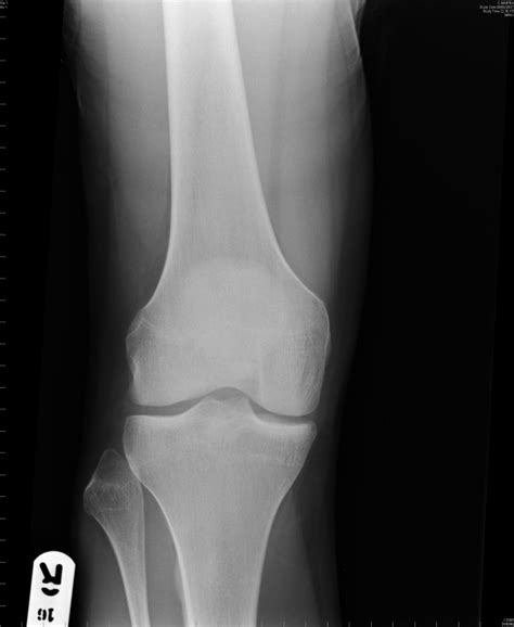 Anterior Posterior View Of The Knee Showing Dislocated Fibular Head