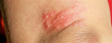What Is Contact Dermatitis Causes Symptoms And Treatment Holland
