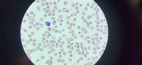 Where Does The Acantho End And The Schisto Begin 😬 R Medlabprofessionals