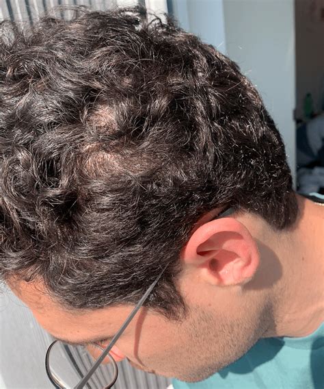 Why Do I Have A Bald Spot On The Side Of My Head R Balding