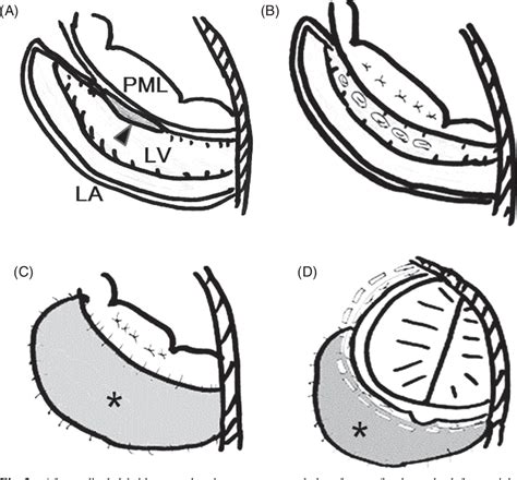 Figure 3 From Paravalvular Abscess Of The Mitral Valve With Fistula To The Left Ventricle And