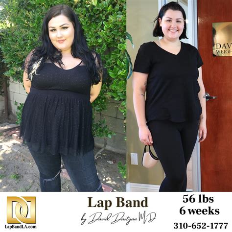 Bariatric Surgery Before And After Brighton T Lap Band Los Angeles
