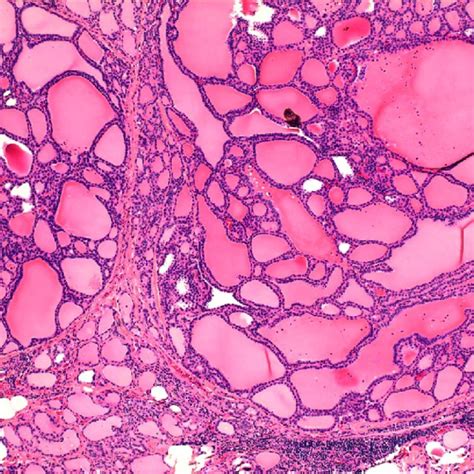 Thyroid Tissue With Hyperplasticadenomatoid Nodules Hande X100