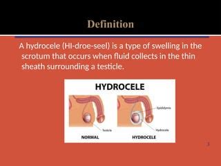 Hydrocele Mbbs Topic New Ppt Uploded By Dev Pptx