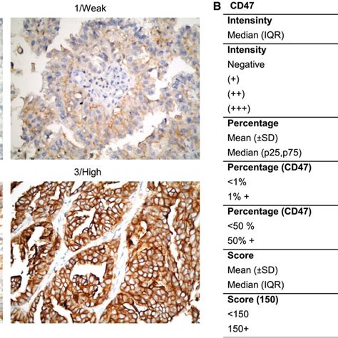 Cd47 Expression In Nsclc Patients A Representative Download