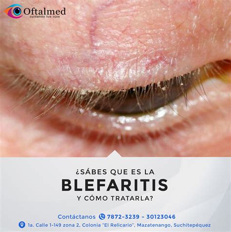 Oftalmed 😣 ¿sabías Que La Blefaritis Es Una Inflamación