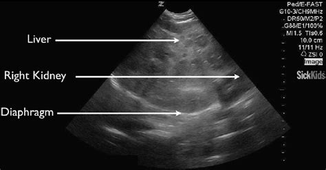 The Standard View Of The Right Upper Quadrant Of The Pocus E Fast Download Scientific Diagram