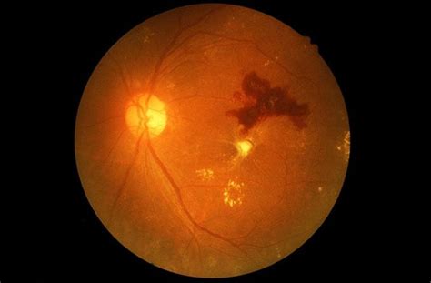 Retinal Hemorrhage And Retinal Bleeding All About Vision