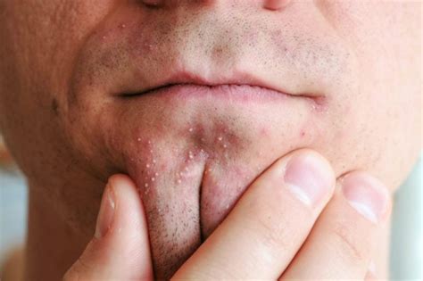 How To Treat Different Types Of Acne Reader S Digest