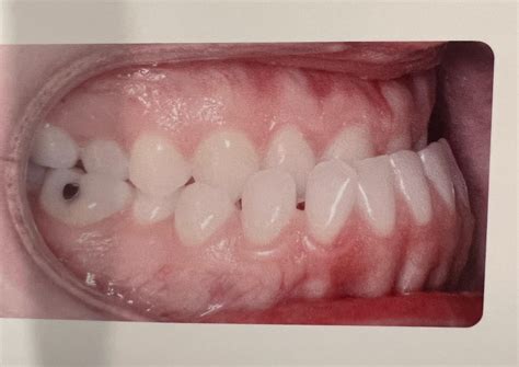 Class Iii Underbite Rjawsurgery
