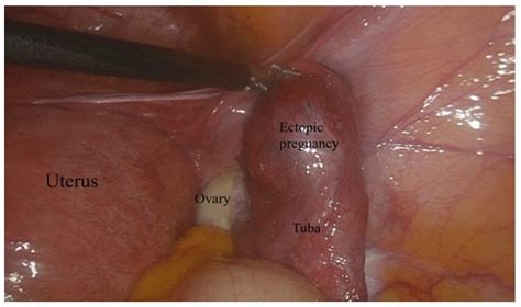 Prediction Of Tubal Rupture In Ectopic Pregnancy Using Methotrexate
