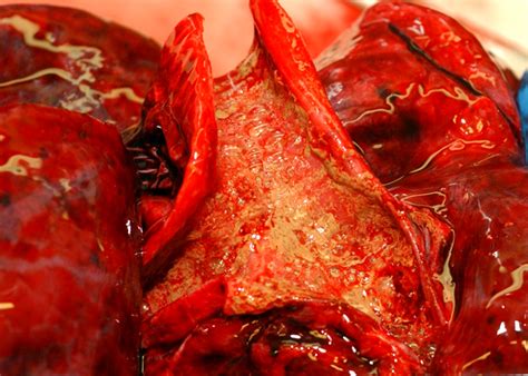 Virtual Autopsy Two And Three Dimensional Multidetector Ct Findings
