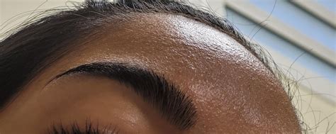 Bumpy Texture On Forehead Is It Fa Or Just Irritated By Previous