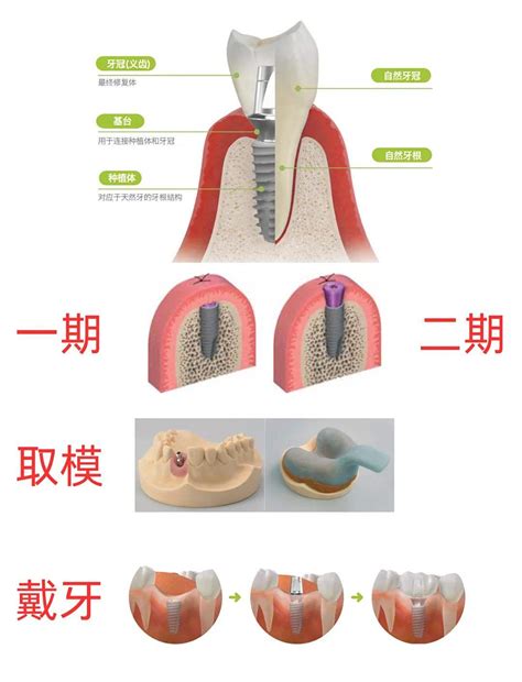 种植牙全流程详解：从拔牙到戴牙