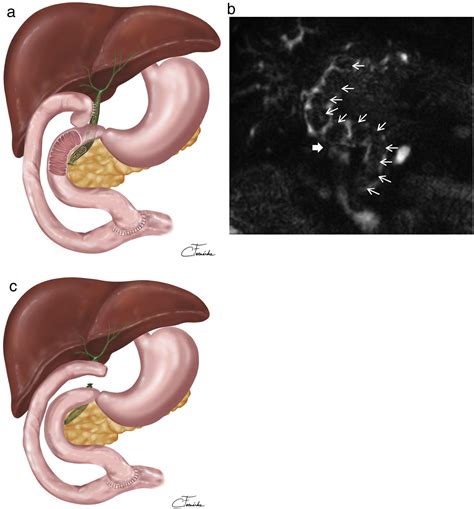 Sump Syndrome As A Late Complication Of Side To Side