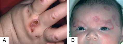 Skin Disorders Innewborn Infants Obgyn Key