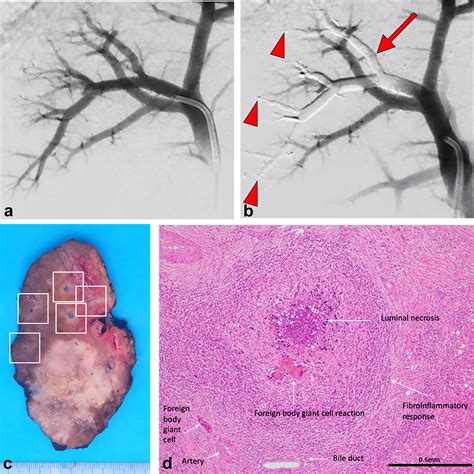 A First In Human Trial Of A New Aqueous Ionic Liquid Embolic Material