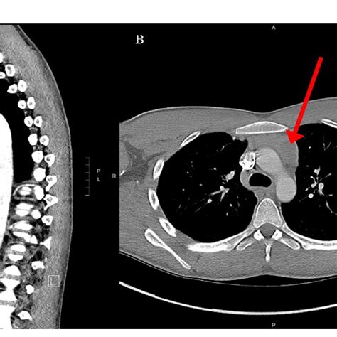 A Nodular Area With Central Low Density In The Left Side Of The