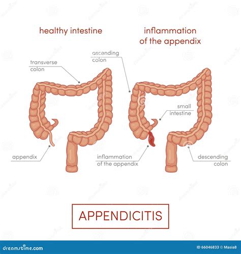 Appendicitis Illustration Stock Illustration Illustration Of