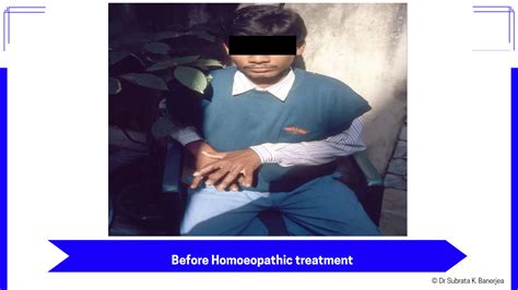 Ach Cured Case Ppt D010 Atopic Vesicular Dermatitis In Hand Bmpptx