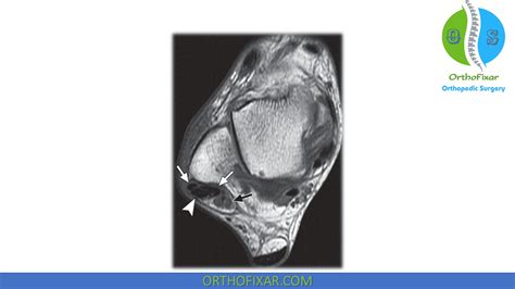 Peroneal Tendinopathy