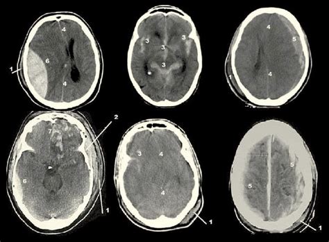 Reconhecendo As Hemorragias Cerebrais Na Tomografia Omelhor