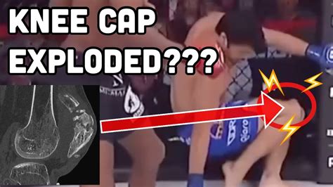 Fighters Knee Cap Explodes Doctor Explains Youtube