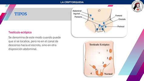 La Criptorquidia DefiniciÓn Tipos Tratamiento Pptx