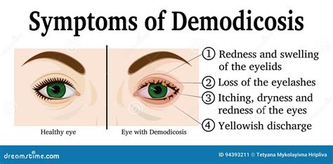 Illustration Of Demodicosis Stock Vector Illustration Of
