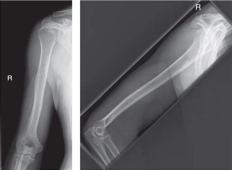 Lateral Humerus X Ray